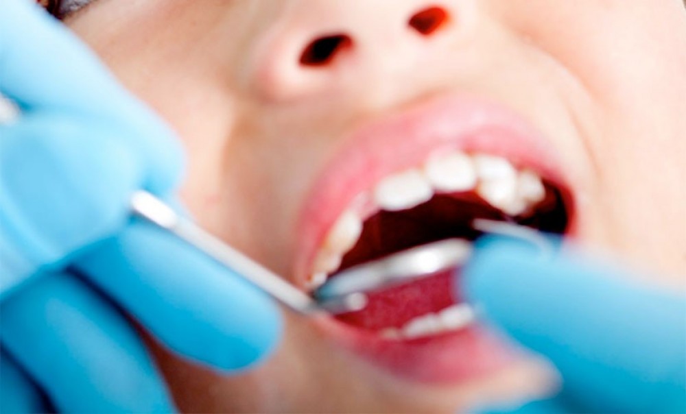 5 6 насны хүүхдийн шүд цоорох өвчний тархалт 89 хувь байна