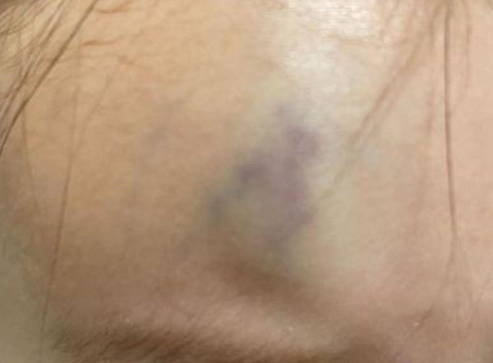 Цэцэрлэгийн багшдаа зодуулсан гэх хүүхдийн гэмтлийг шинжээч эмч томилон шалгаж байна